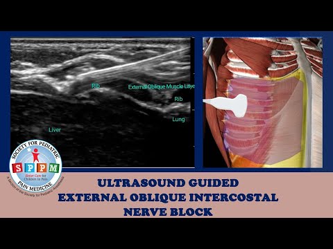 External Oblique Intercostal Ultrasound Guided Nerve Block - YouTube