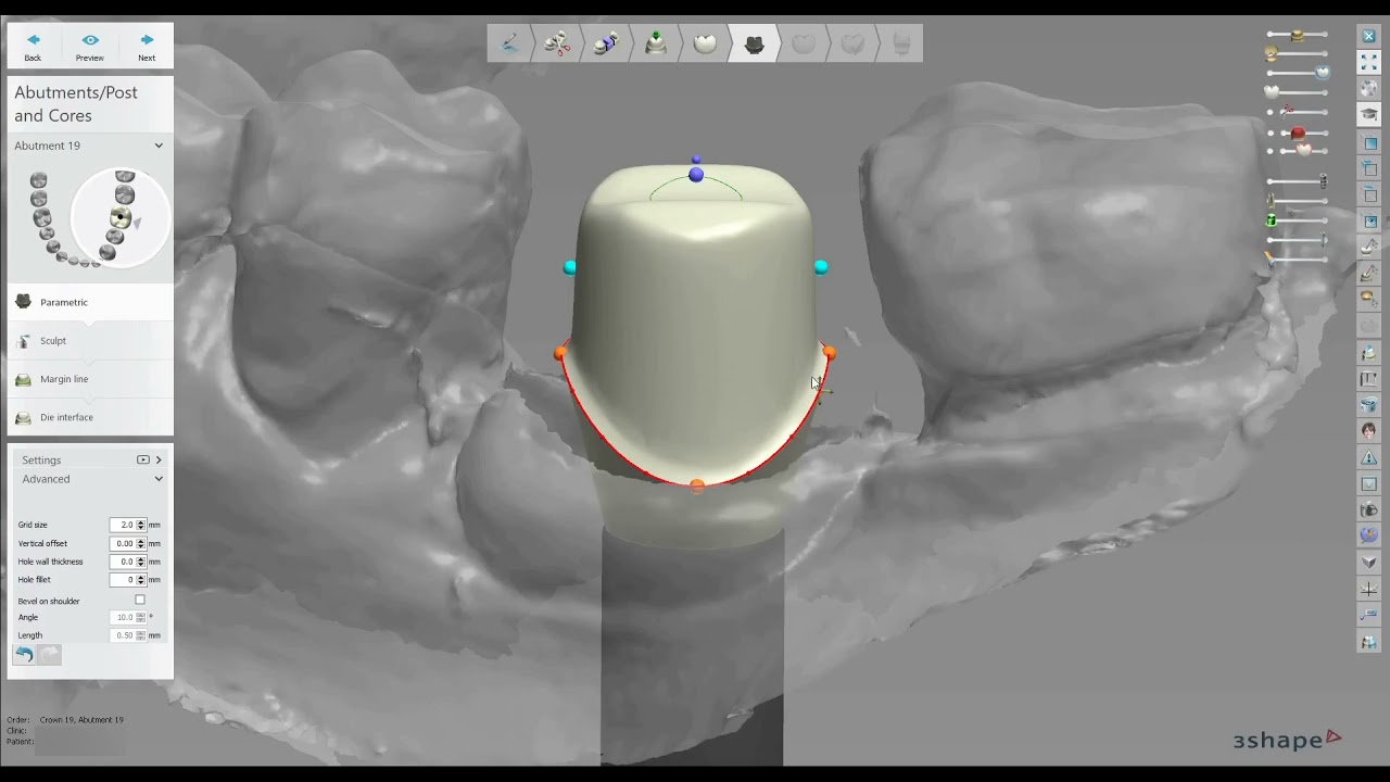 3Shape Digital Lab Workflow Utilizing the Anatotemp SC - YouTube