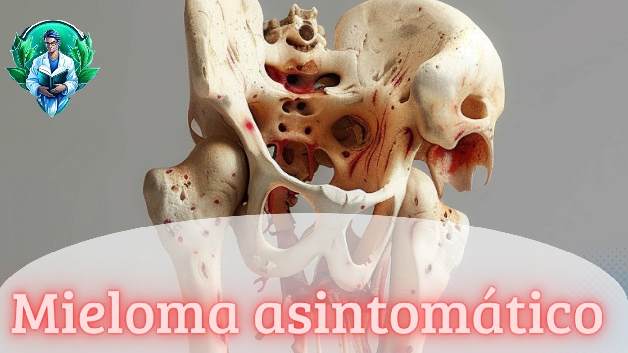 Mieloma Múltiple Asintomático: Lo que Debes Saber👨‍⚕️ - YouTube