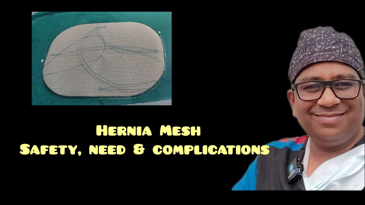 Hernia mesh, its safety, need & its problems - YouTube
