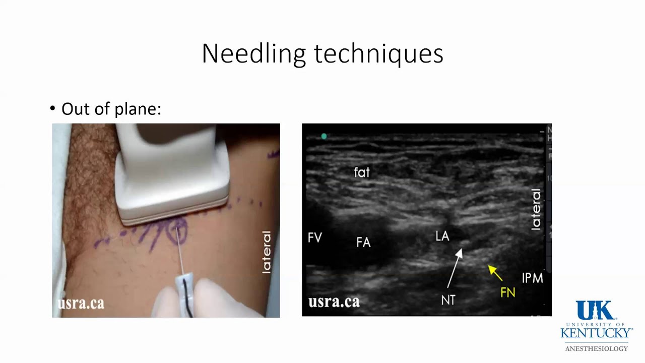 20160328 PNB : Common Upper Extremity Blocks - YouTube