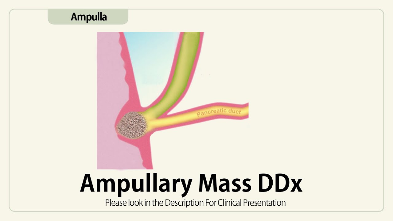 Ampullary Mass DDx - YouTube