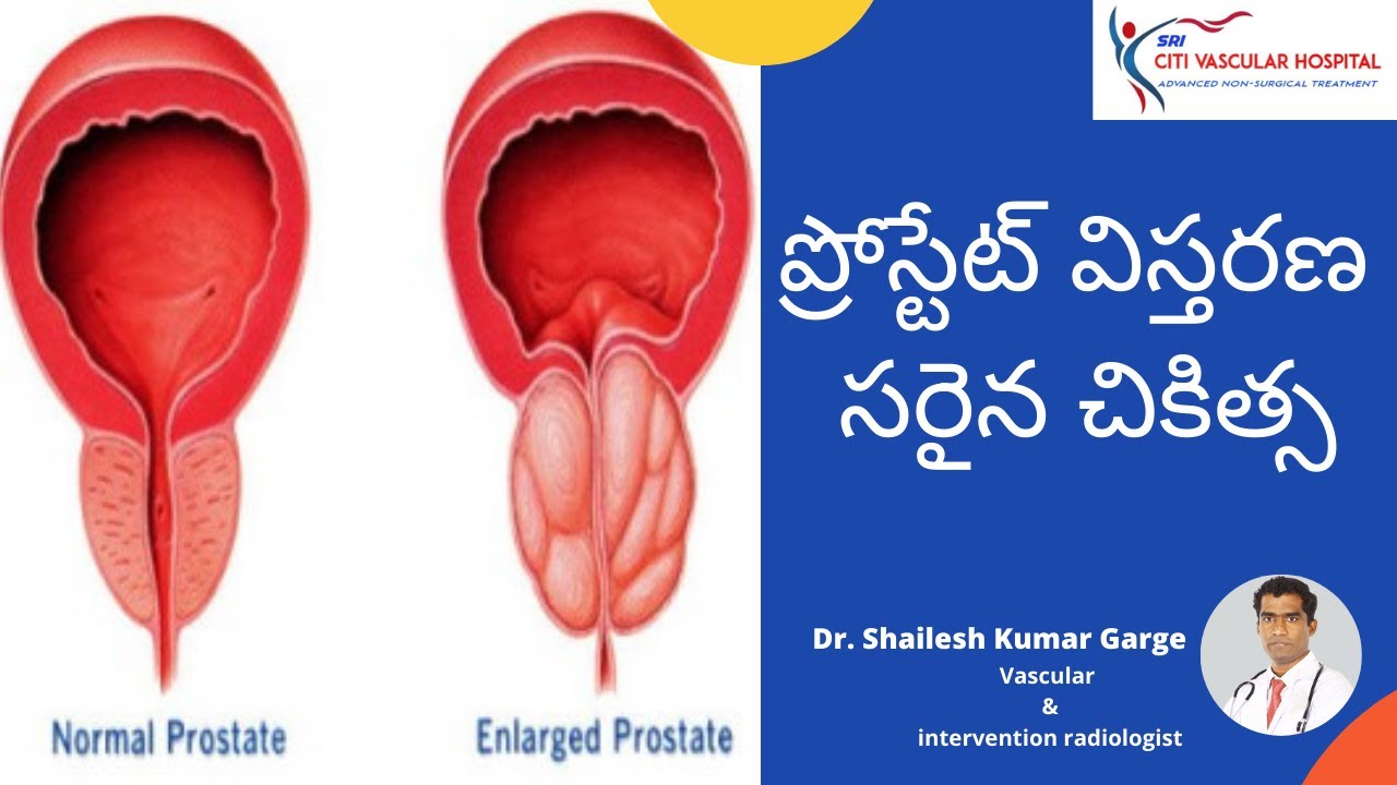 Best Treatment For Benign Prostate Enlargement In Telugu By Prostate