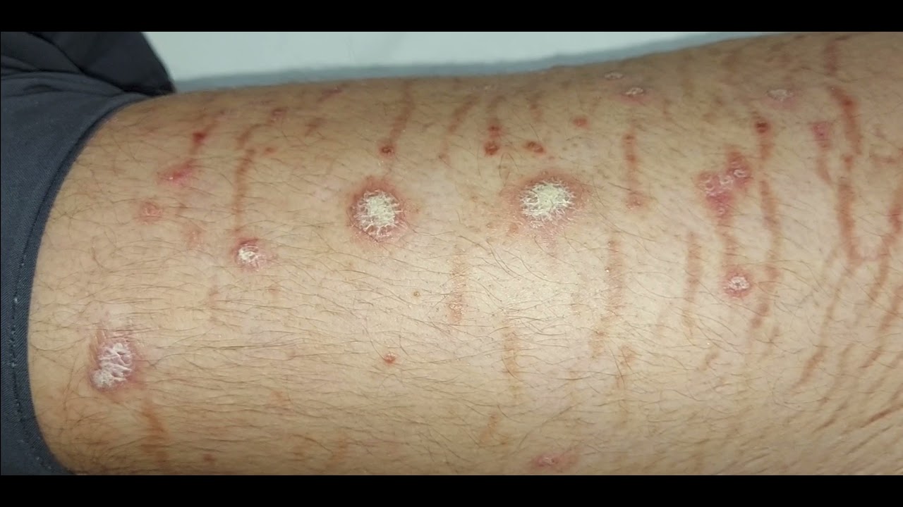 Psoriasis and Steroid Induced Striae - YouTube