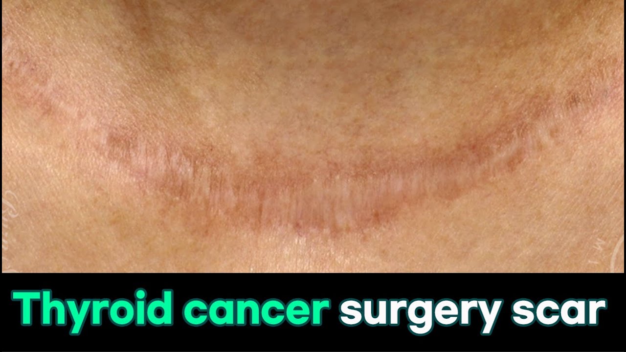 Thyroid cancer surgery scar after 5 years of Pinholxell laser treatment ...