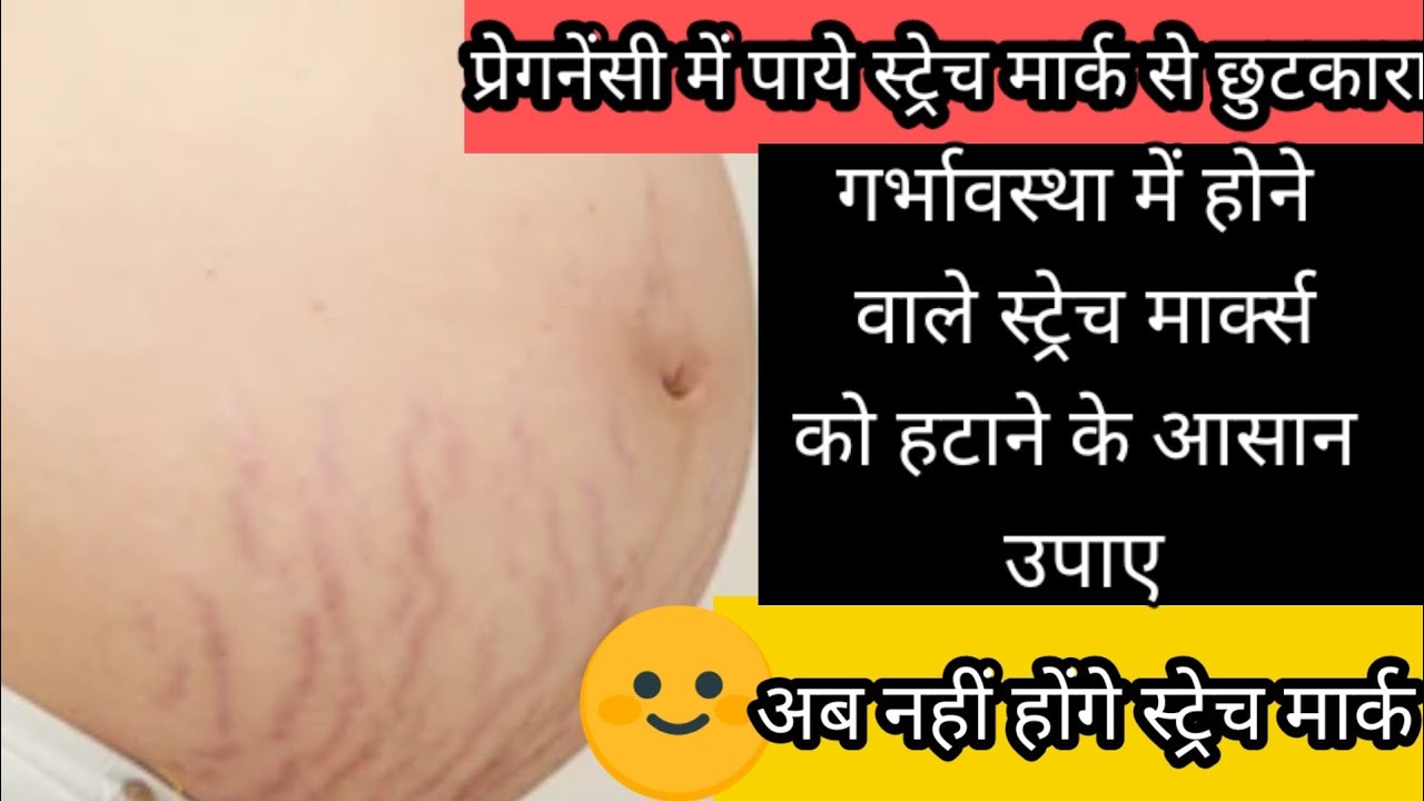 प्रेगनेंसी में होने वाले स्ट्रेच मार्क हटाने के उपाय // how to remove ...