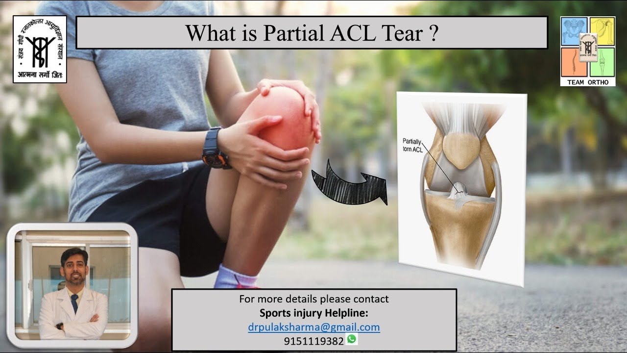 Understanding Partial ACL Tear - YouTube