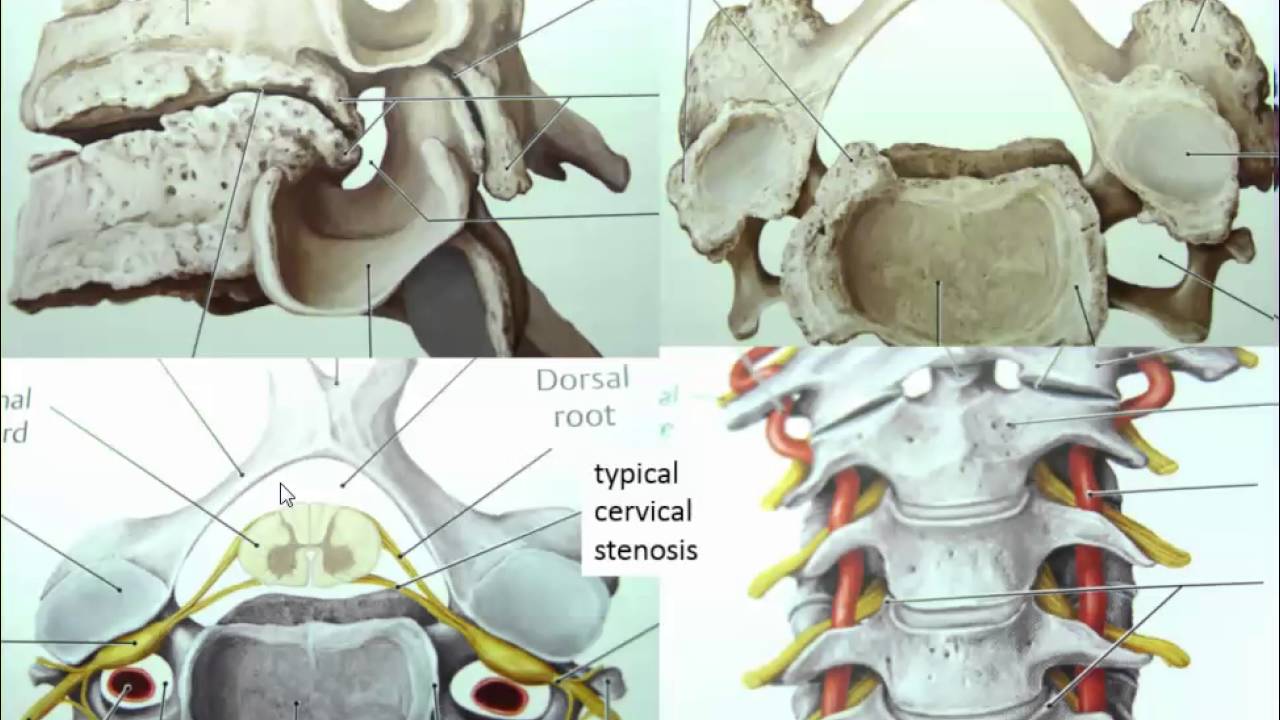 Spine Conference: revision posterior cervical fusion for progression of ...