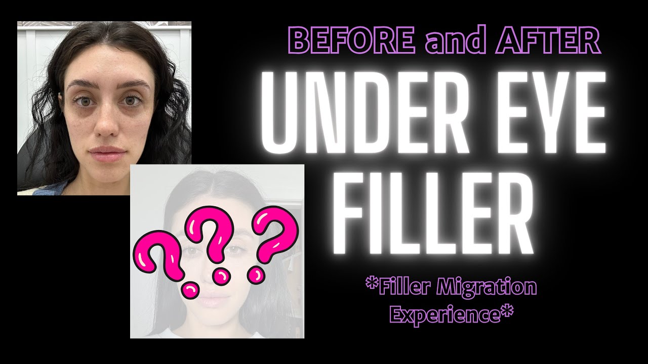 Under Eye Filler + Migration experience - YouTube