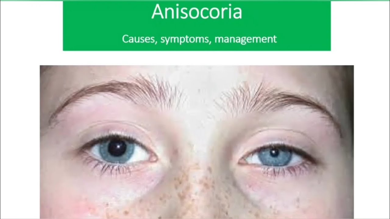 Pupil abnormality series lecture 5: Anisocoria | causes | diagnosis ...