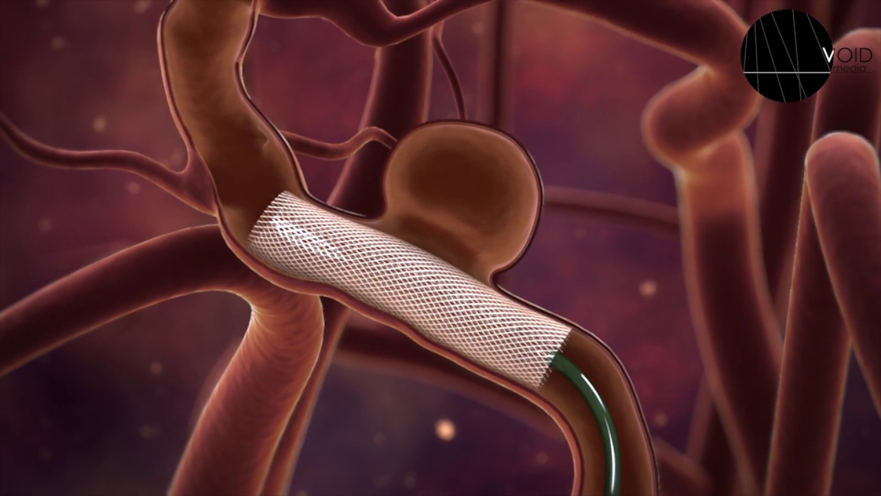 VOID Cleveland Clinic AD Non Invasive Treatment of Brain Aneurysms ...