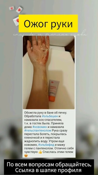 ожог руки - YouTube