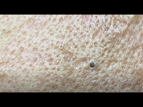Two HUGE Dilated Pores of Winer!! - YouTube