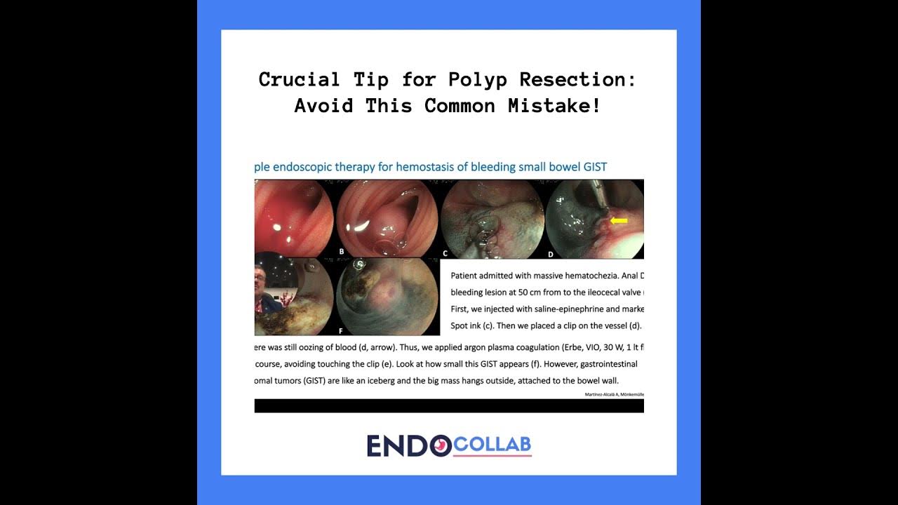 Crucial Tip for Polyp Resection: Avoid This Common Mistake! - YouTube