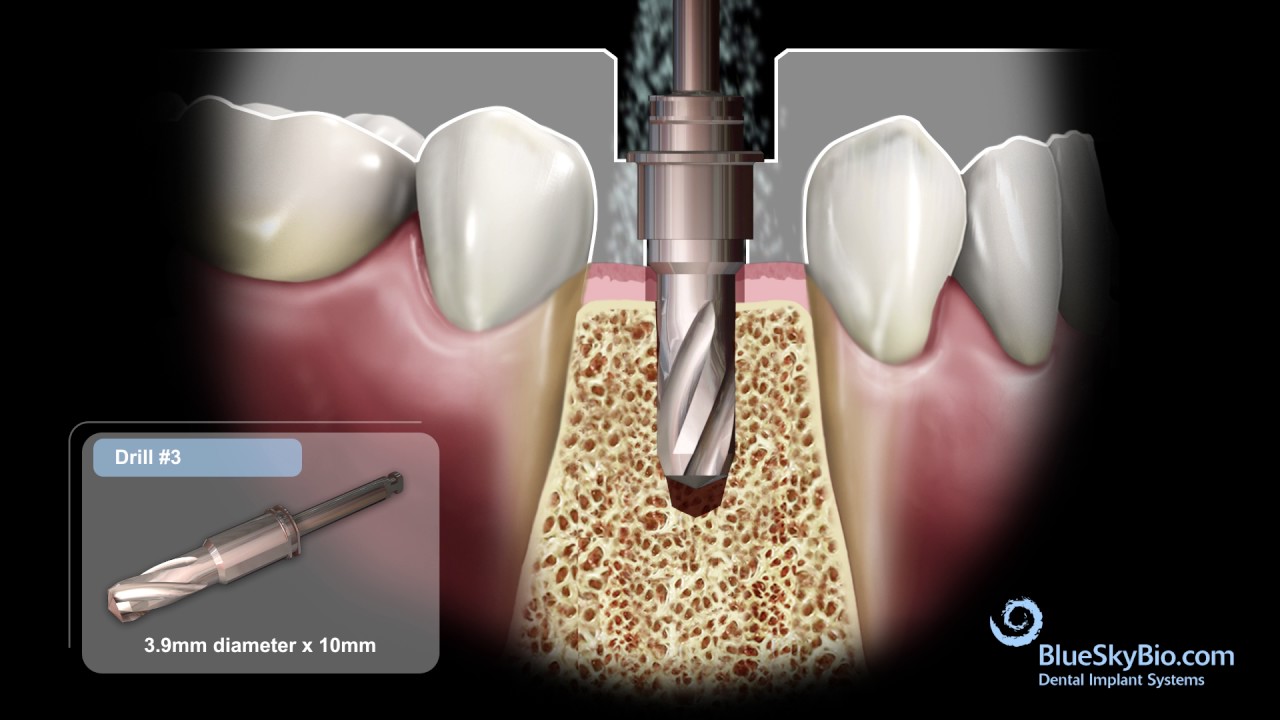 BIO | Max Fully Guided Surgical Kit (5.0mm Implant) - YouTube