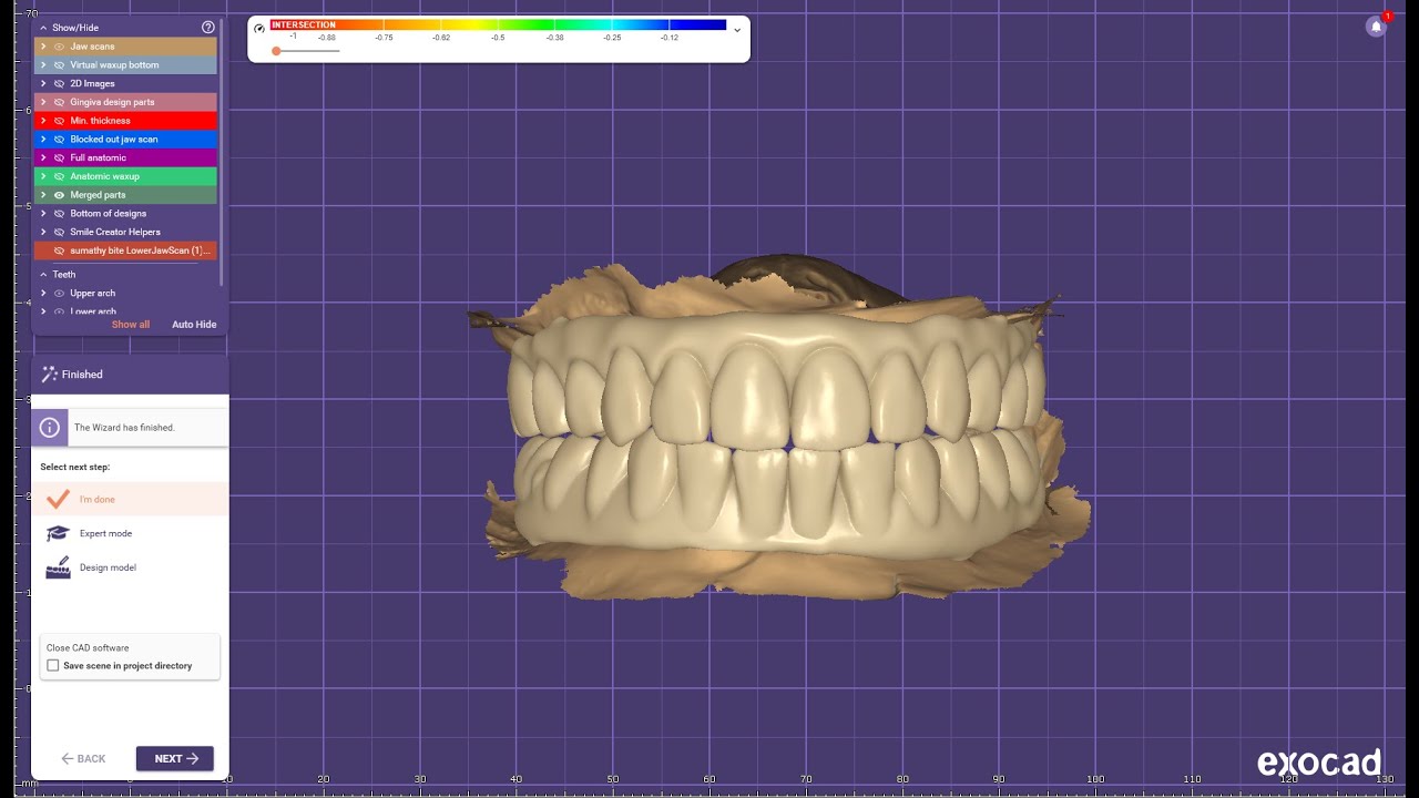 Upper/lower full arch designing for on substucture in exocad elefsina 3 ...