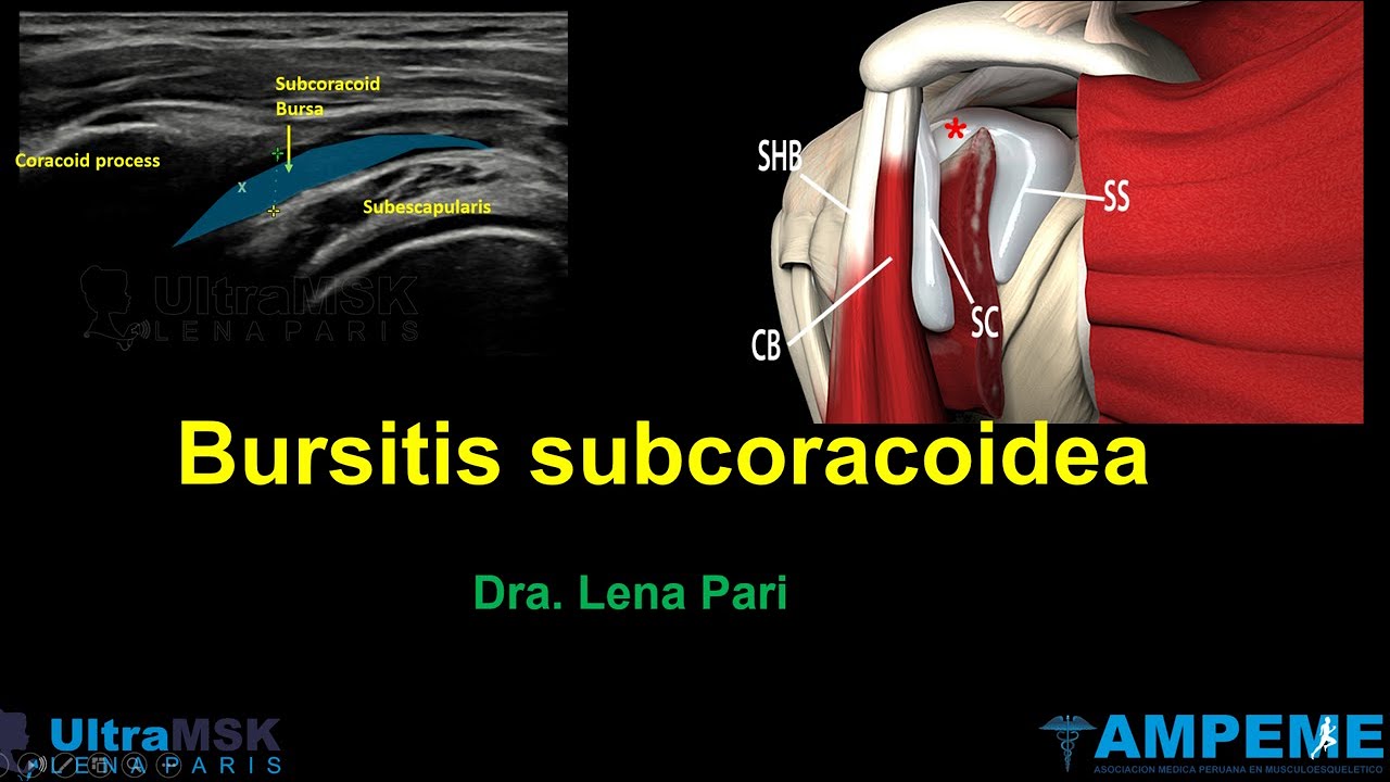 Como evaluar la bursitis subcoracoidea? Dra. Lena Pari - YouTube