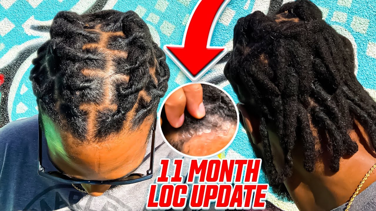 11 Month Loc Update | Seborrheic Dermatitis Flare Up Loc Journey Woes ...