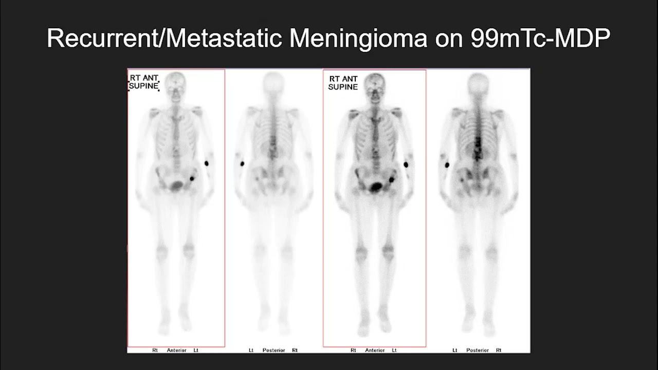 Nuclear medicine imaging in brain neoplasm - YouTube