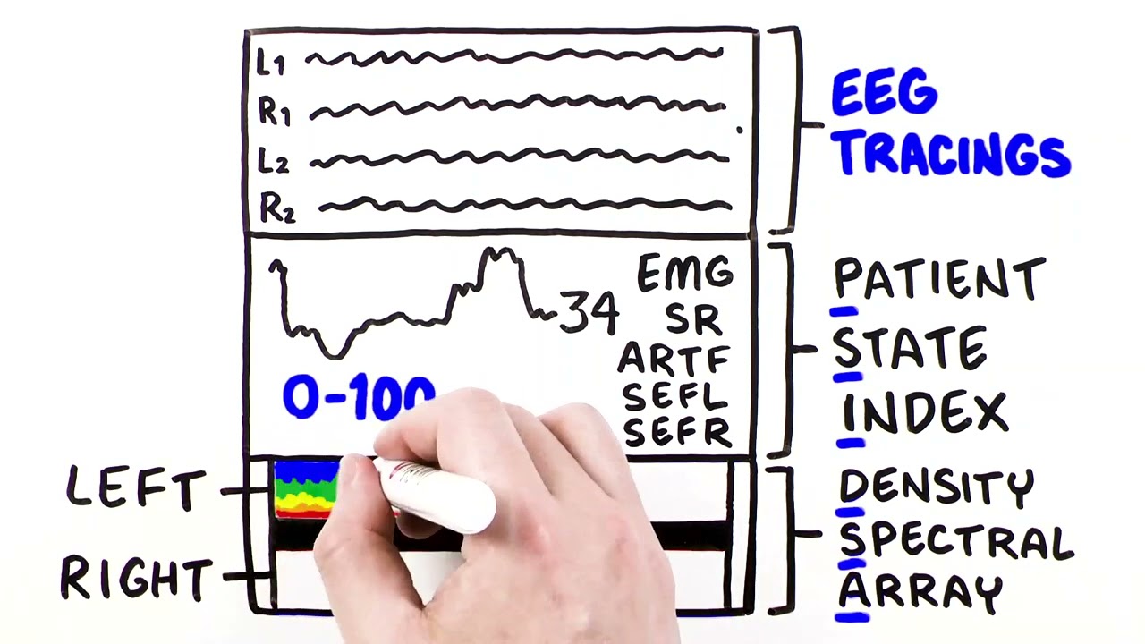 Monitoreo de la función cerebral SedLine: Interpretación de la matriz ...
