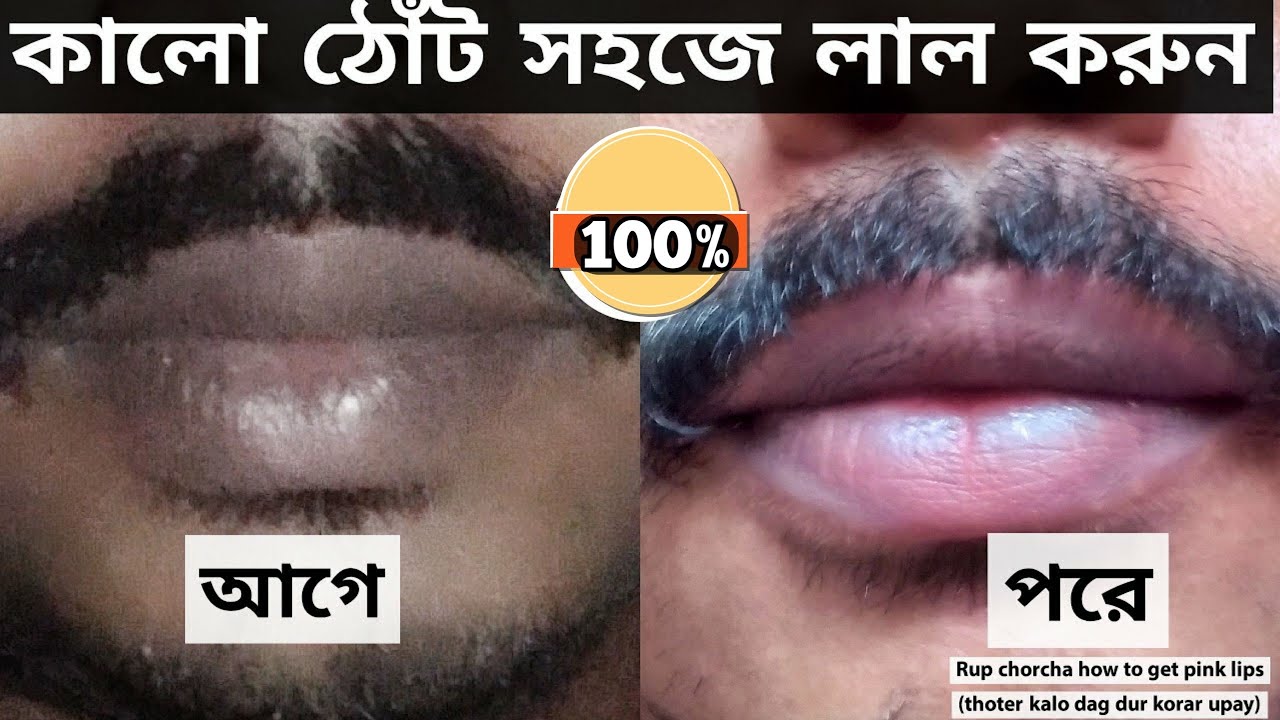 Rupchorcha 🔴 2দিনে কালো ঠোঁট গোলাপি করার উপায় (thoter kalo dag dur ...