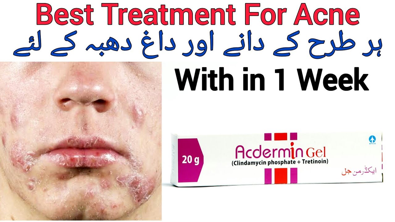 Acdermin Gel Uses | Acdermin Gel For Acne in Urdu | How to Use Acdermin ...