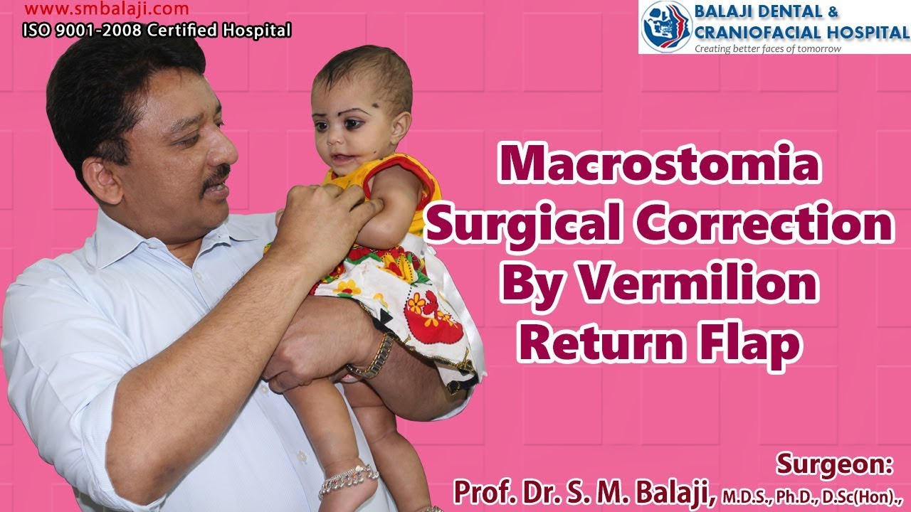 Macrostomia - Surgical Correction By Vermilion Return Flap - YouTube