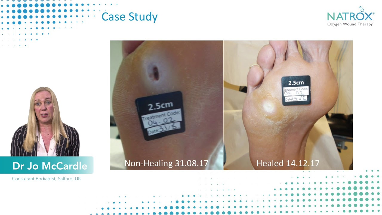Optimizing Diabetic Foot Ulcer Treatment: NATROX® O₂ Topical Oxygen ...