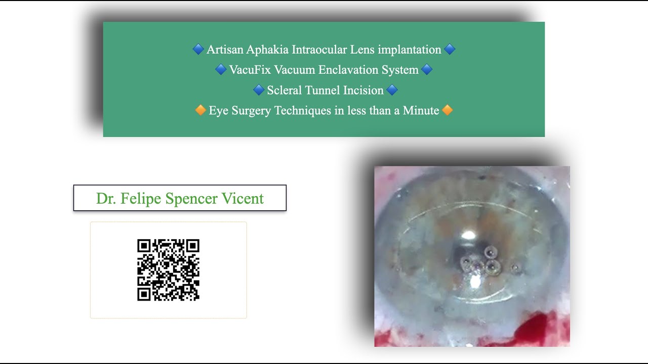 Artisan Aphakia Intraocular Lens Implantation. - YouTube