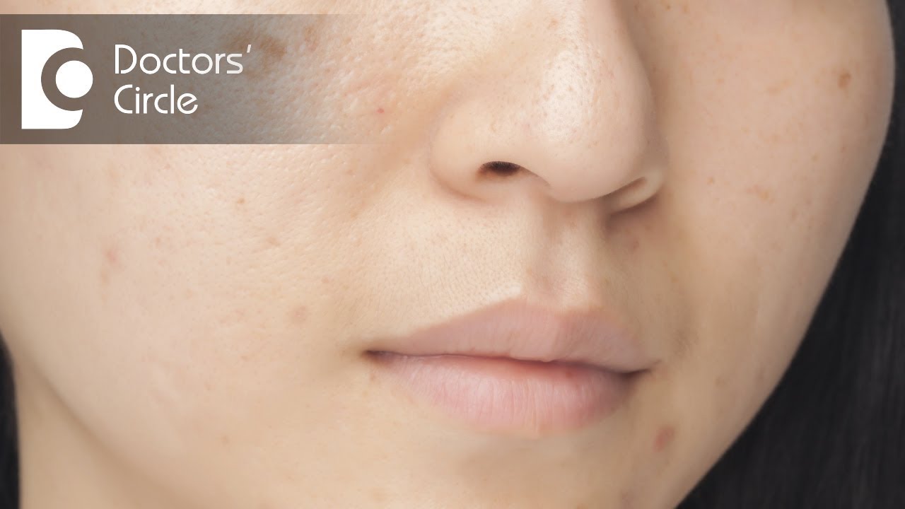 How to manage hyperpigmentation of pubic area? - Dr. Amee Daxini - YouTube