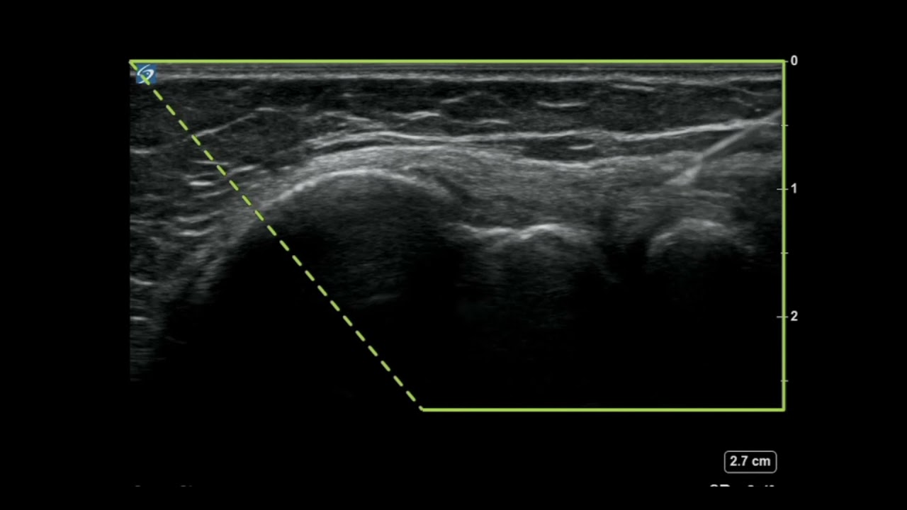 Elbow US Lateral Epicondyle Injection - YouTube