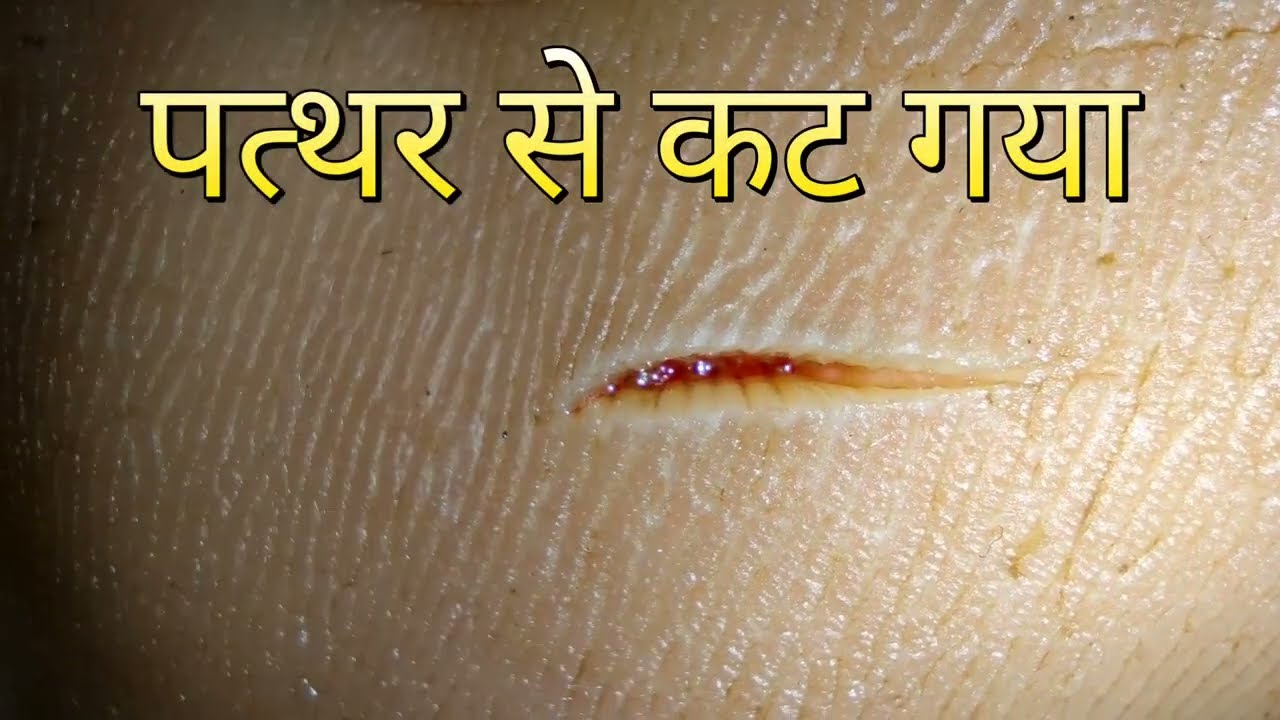 How To Remove Cut On Foot Dettol how-to-remove-cut-on-foot-dettol