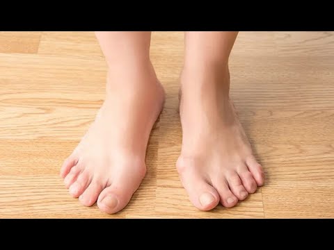Ayak Üstünde Kemik Çıktıntısı Neden Olur ? Tedavisi Nedir ?