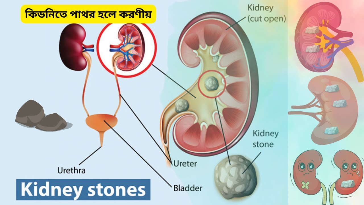 Kidney Stones Types Formation Treatment Prevention Nephrolithiasis ...