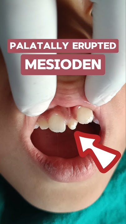 🇳🇵Palatally Erupted Mesiodens| Extra Teeth| Supernumerary Tooth| Forcep ...