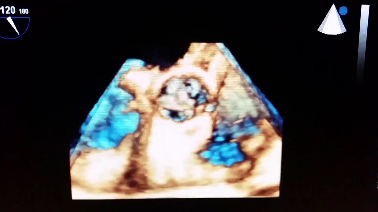 Echocardiogram 3D - Aortic Valve vegetation - YouTube