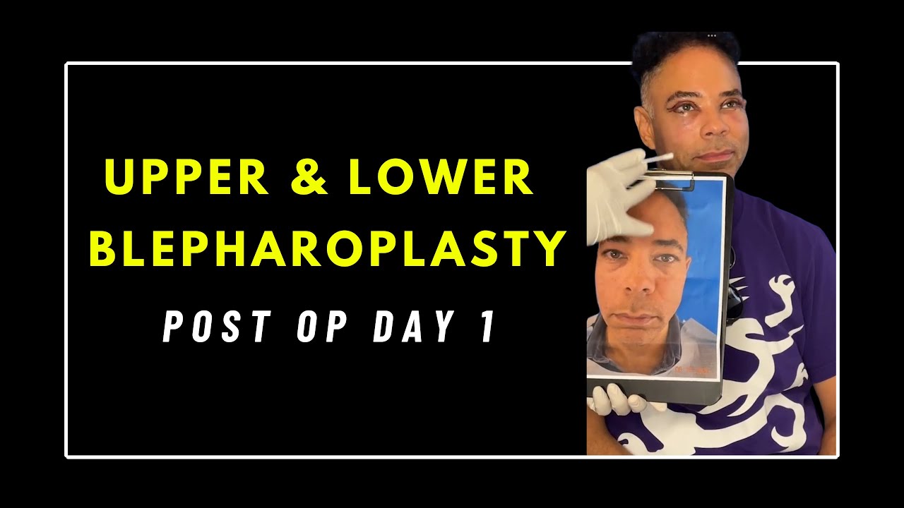 Post-Op Day 1 Upper & Lower Eyelid Surgery - YouTube