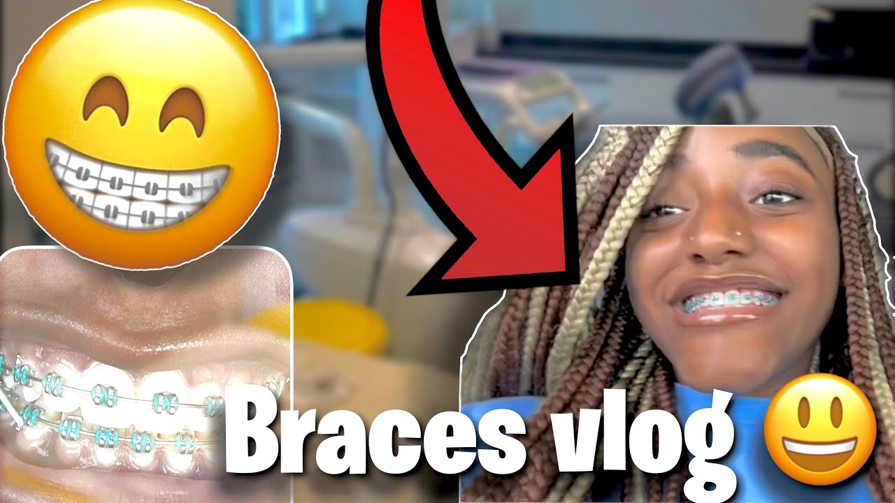 Going To Get Braces Vlog 2023| I Got Braces Results After 3 Months ...