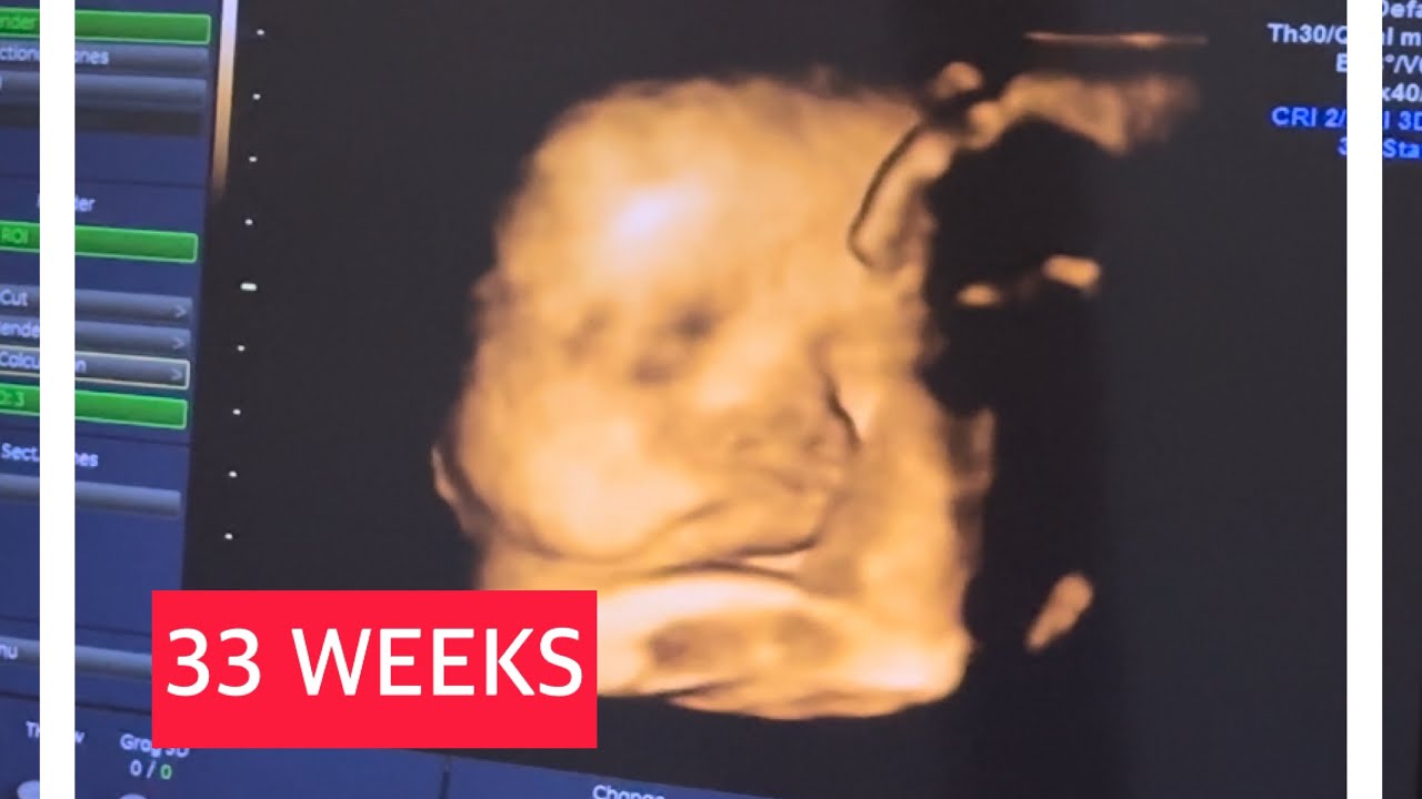 33 WEEKS ULTRASOUND RESULT - YouTube