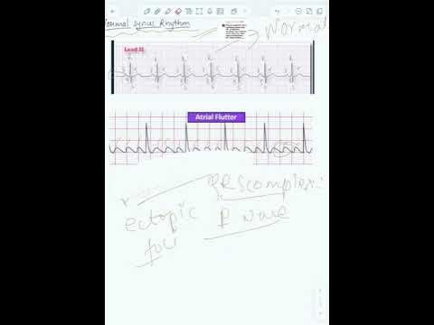 ECG Interpretation | Atrial Flutter| - YouTube