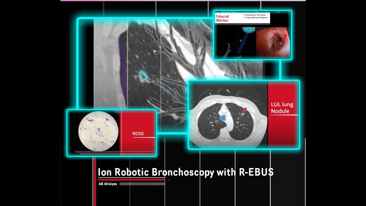 Ion Robotic Bronchoscopy with Radial EBUS - YouTube