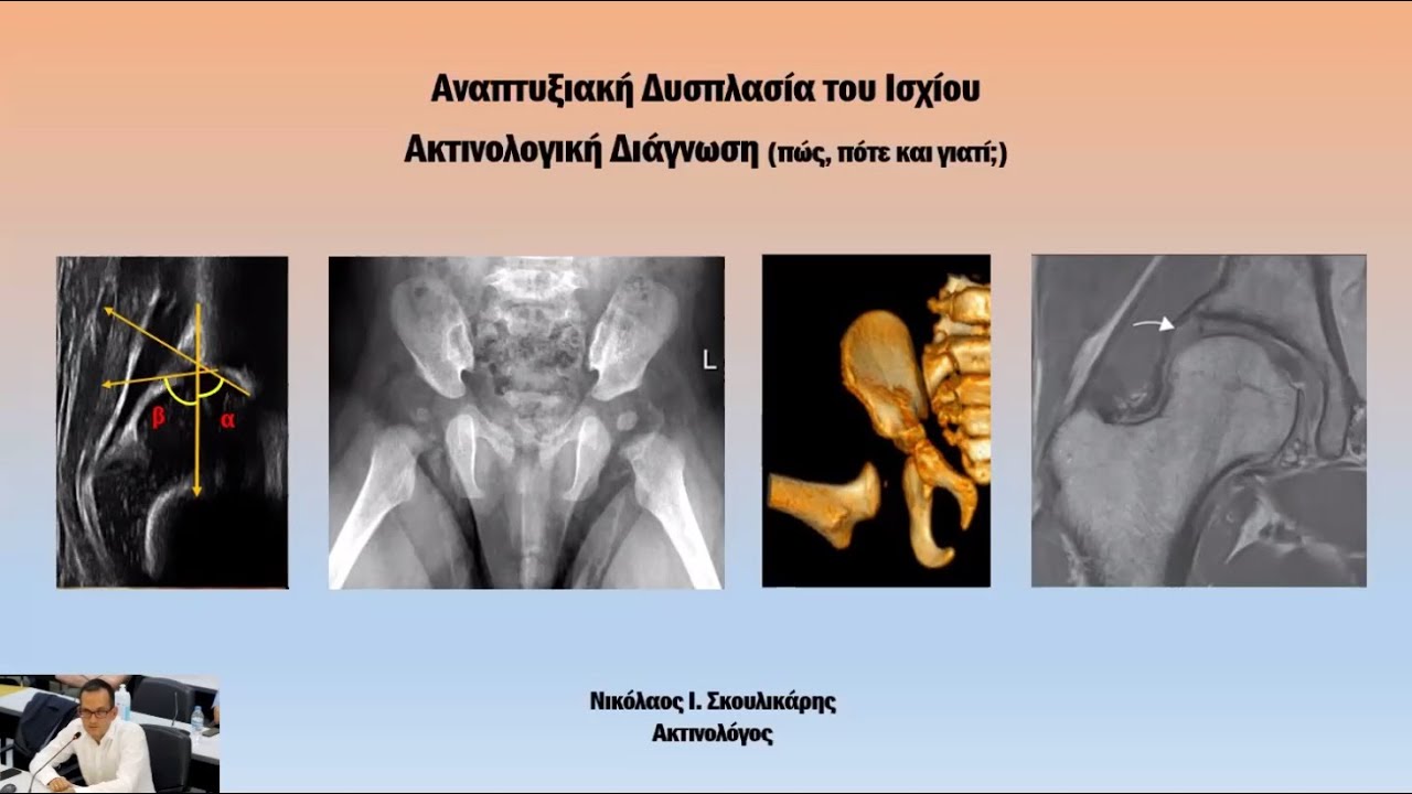 Αναπτυξιακή δυσπλασία του ισχίου - YouTube