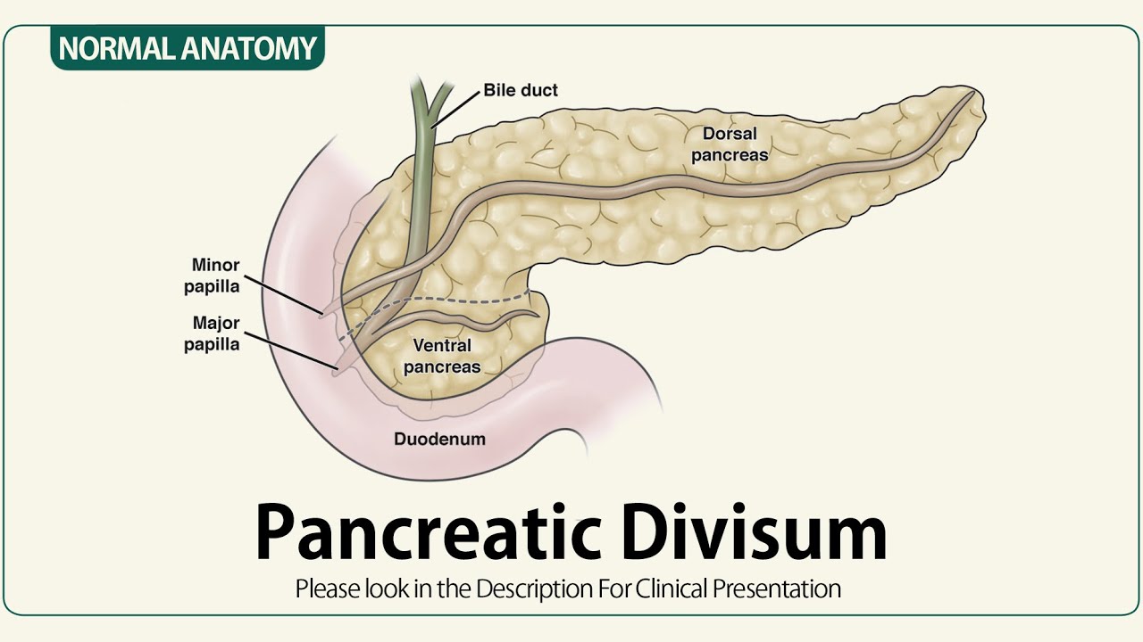 Pancreatic Divisum - YouTube