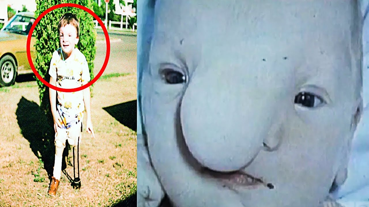 When This Newborn’s Mother First Saw His Severely Deformed Face, She ...