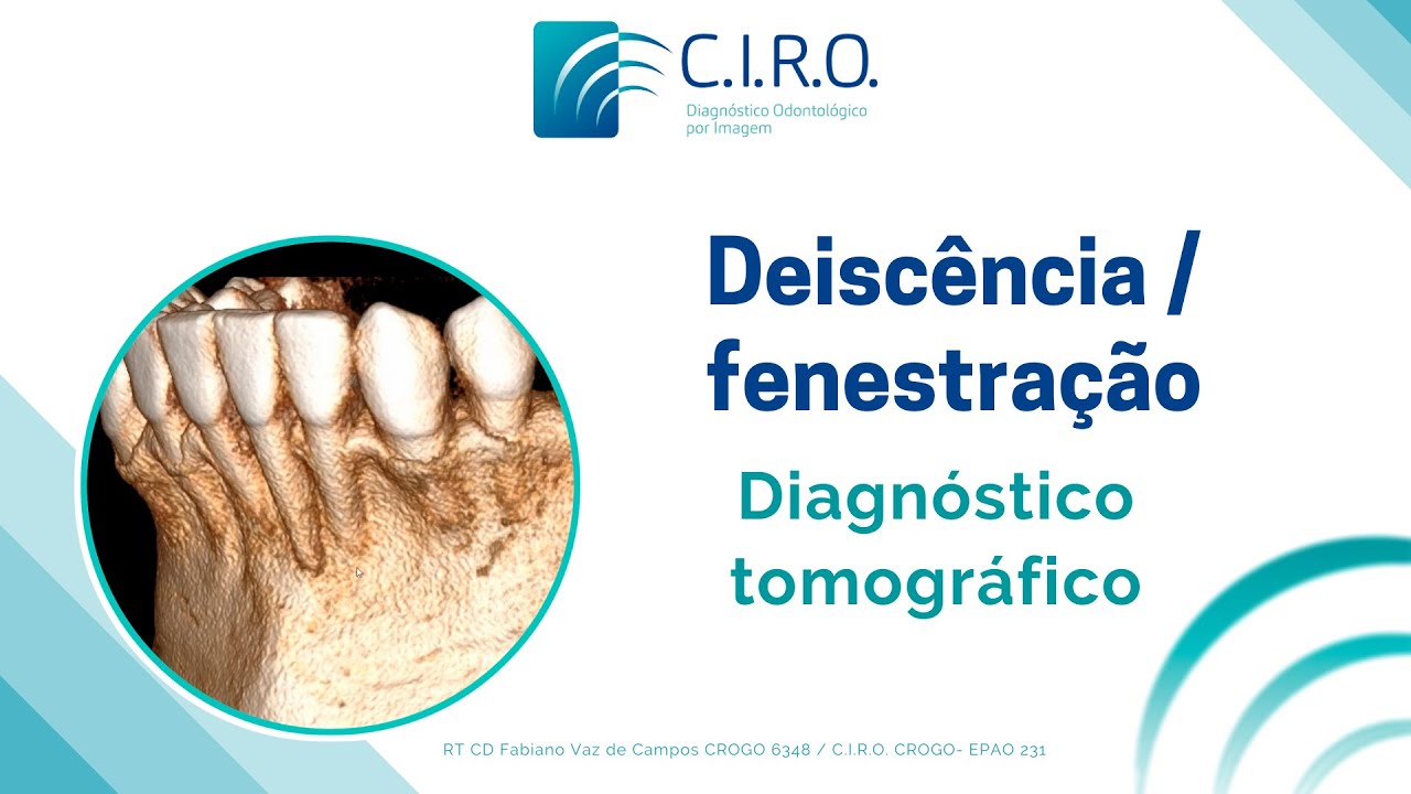 Deiscência / Fenestração: diagnóstico tomográfico - YouTube