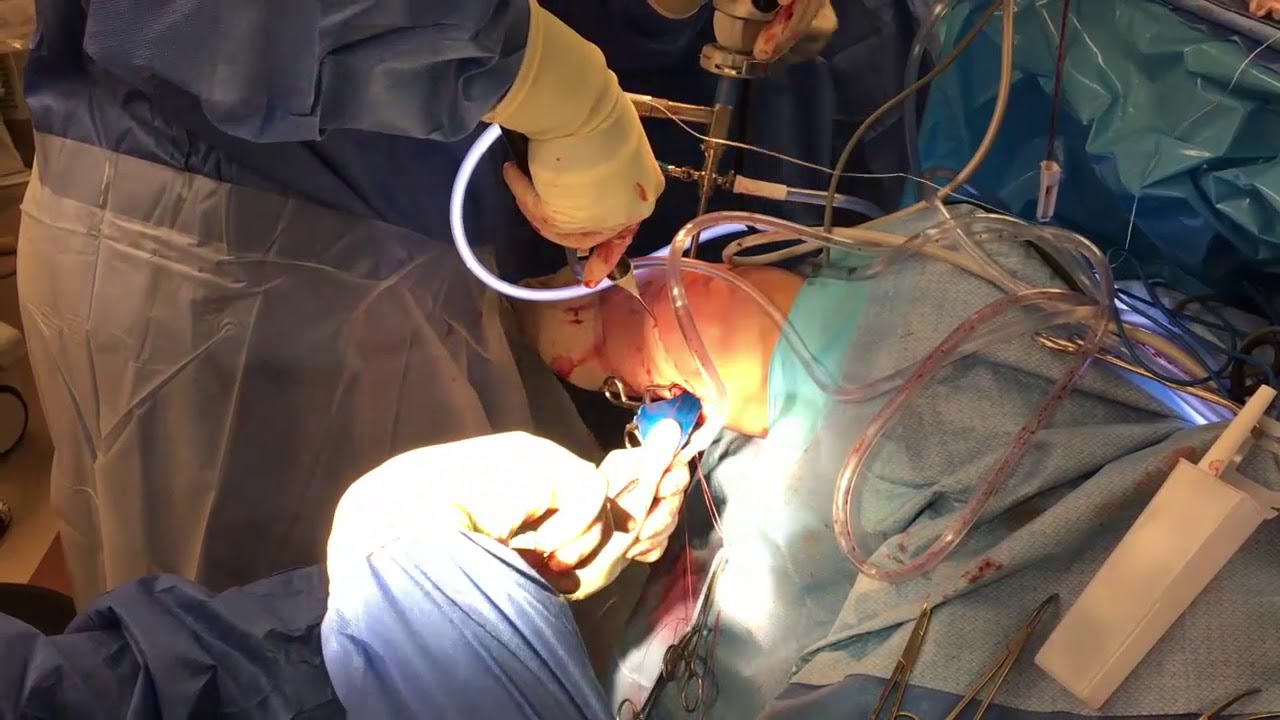 Inside-Out Bucket-Handle Meniscus Repair With a Single-Handed Self ...