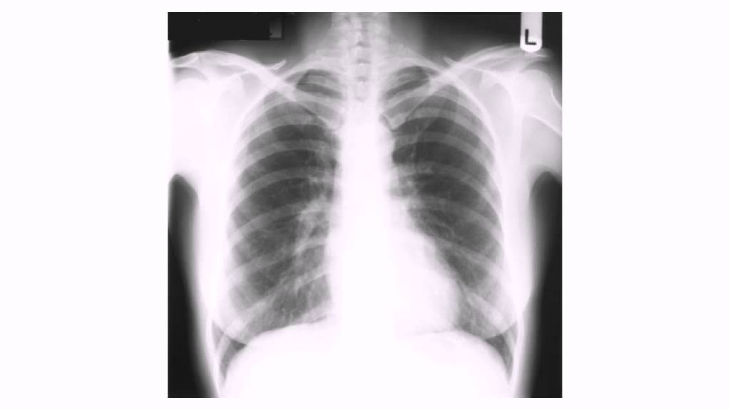 CXR Quick Reading Tips - YouTube
