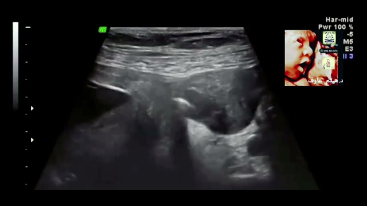 Gs with IUD by superficial ultrasound - YouTube