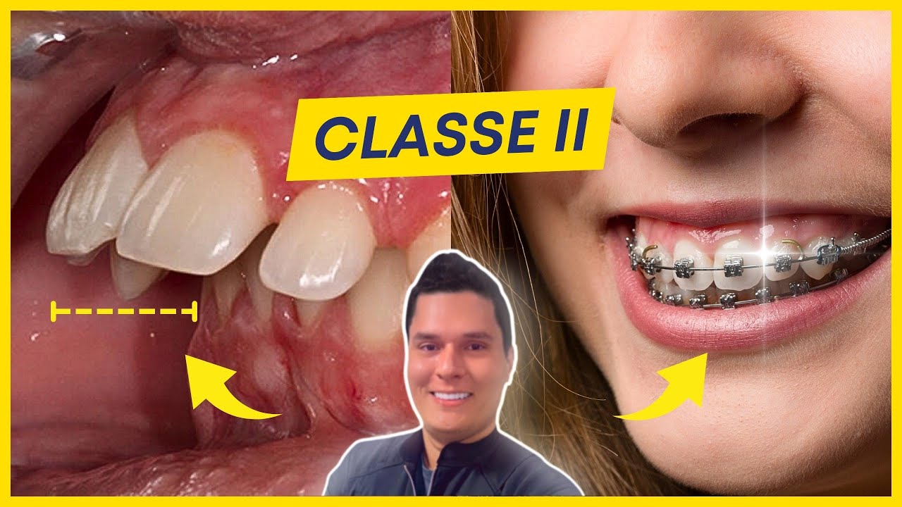 CLASSE 2 EM ORTODONTIA: COMO TRATAR? - YouTube