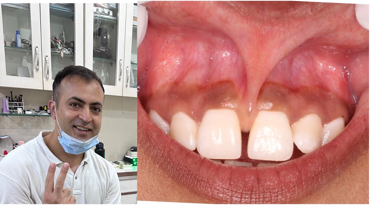 Achieving Ideal Midline Alignment with Composite Restoration after ...